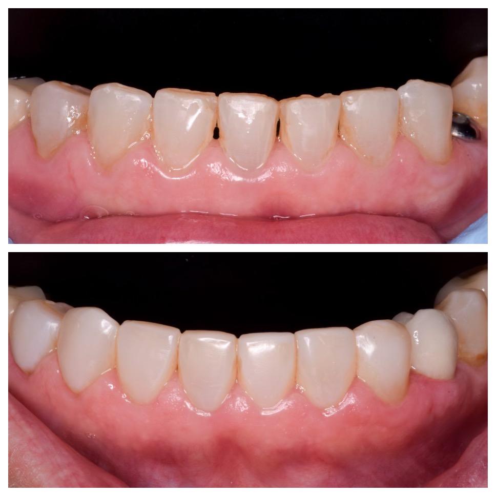 Bioclear Simi Valley, CA | Simi Hills Dental